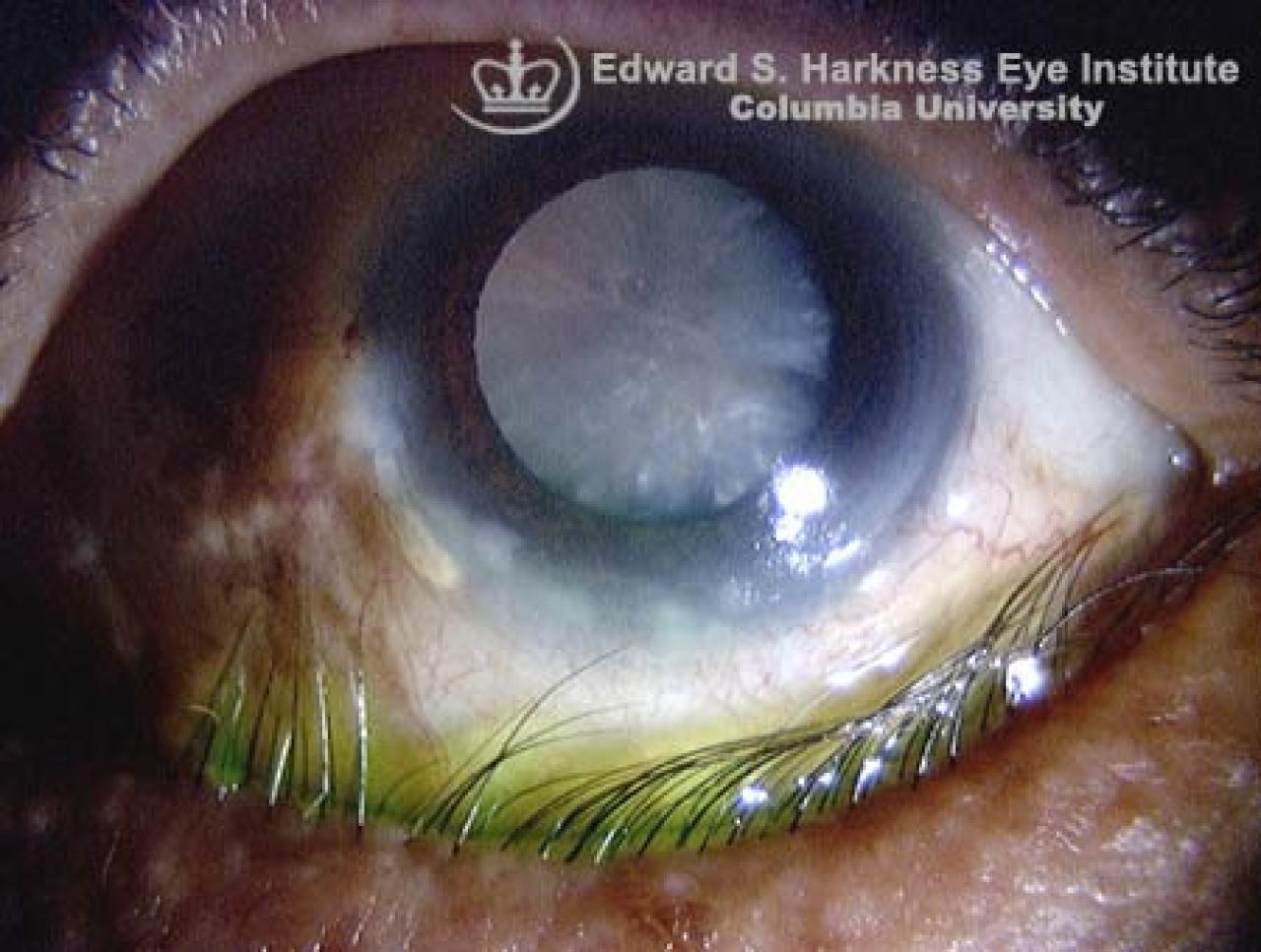 Entropion | Vagelos College of Physicians and Surgeons