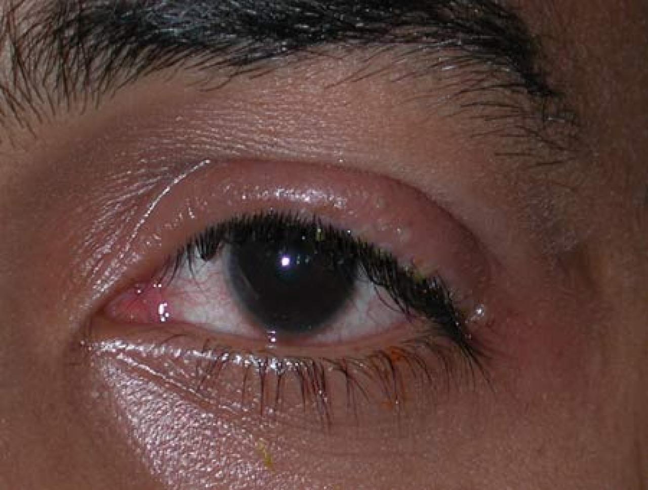 HSV Blepharitis | Vagelos College of Physicians and Surgeons