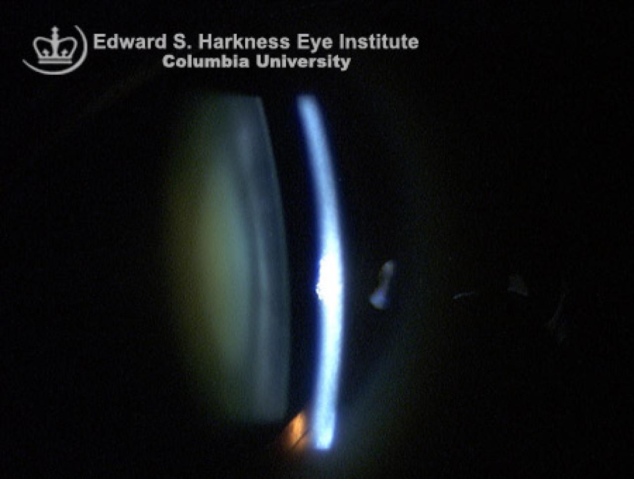 Nuclear Sclerotic | Vagelos College of Physicians and Surgeons