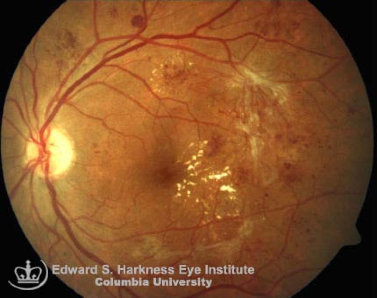 Proliferative Diabetic Retinopathy (PDR) | Vagelos College of ...