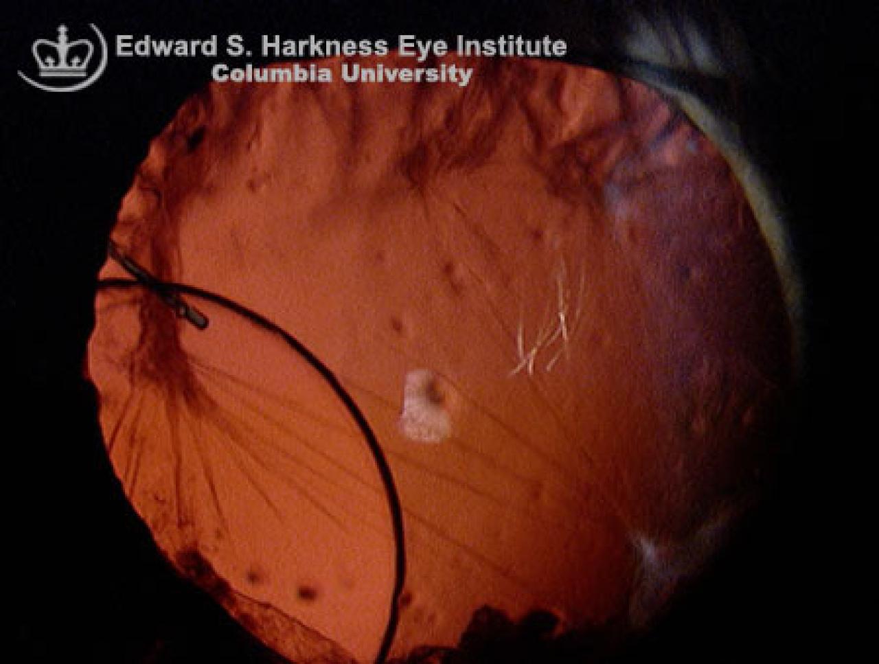 Sunset Syndrome | Vagelos College of Physicians and Surgeons