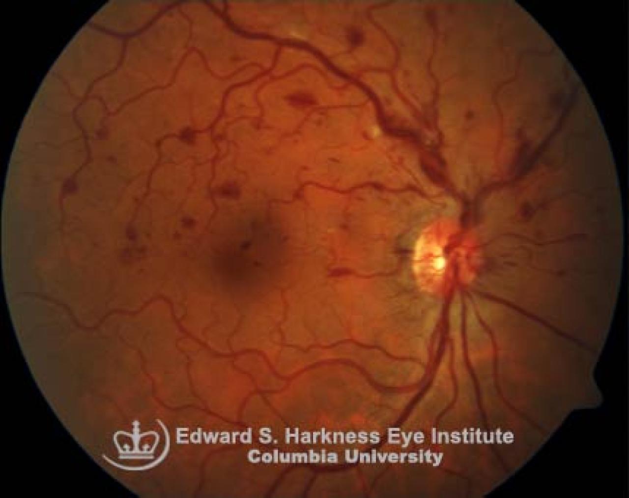 Superior Hemicentral Retinal Vein Occlusion | Vagelos College of ...