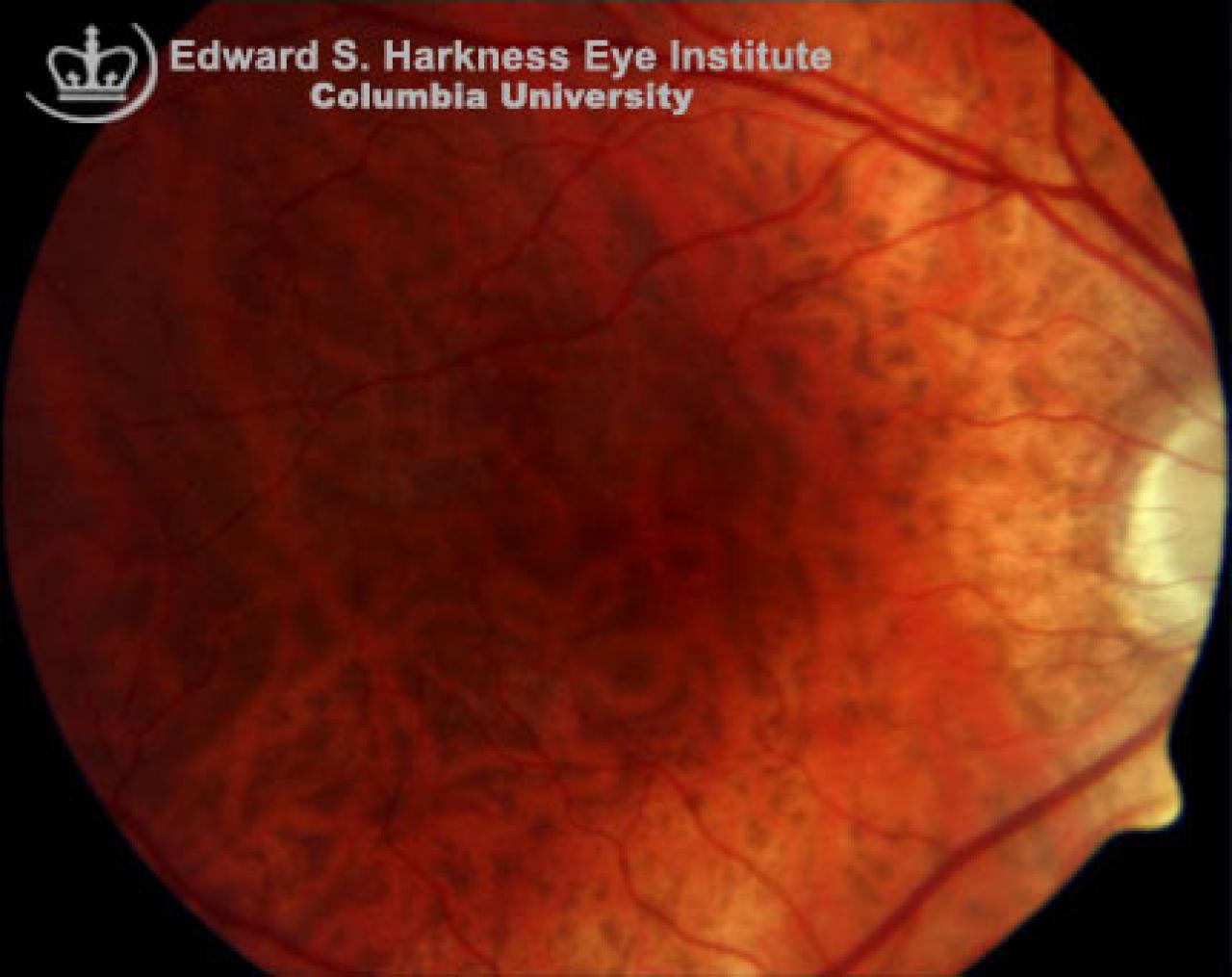 Tesselated Fundus | Vagelos College of Physicians and Surgeons