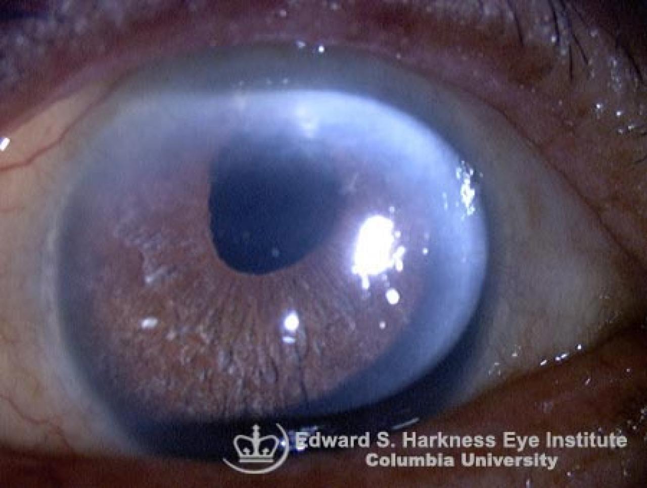 Updrawn Pupil | Vagelos College of Physicians and Surgeons