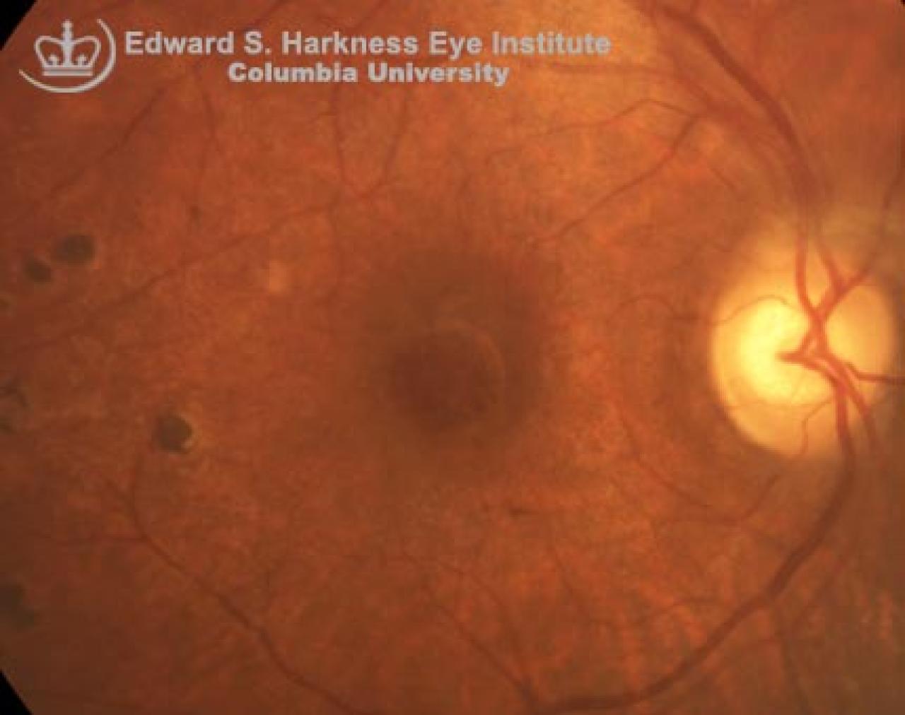 Vitreomacular Traction Syndrome | Vagelos College of Physicians and ...