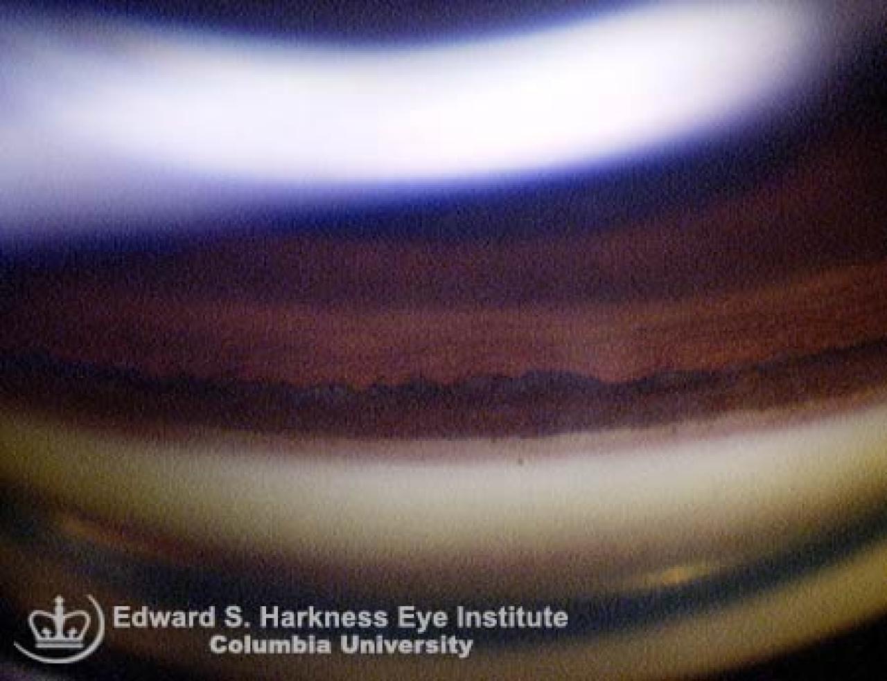 Angle Recession | Vagelos College of Physicians and Surgeons