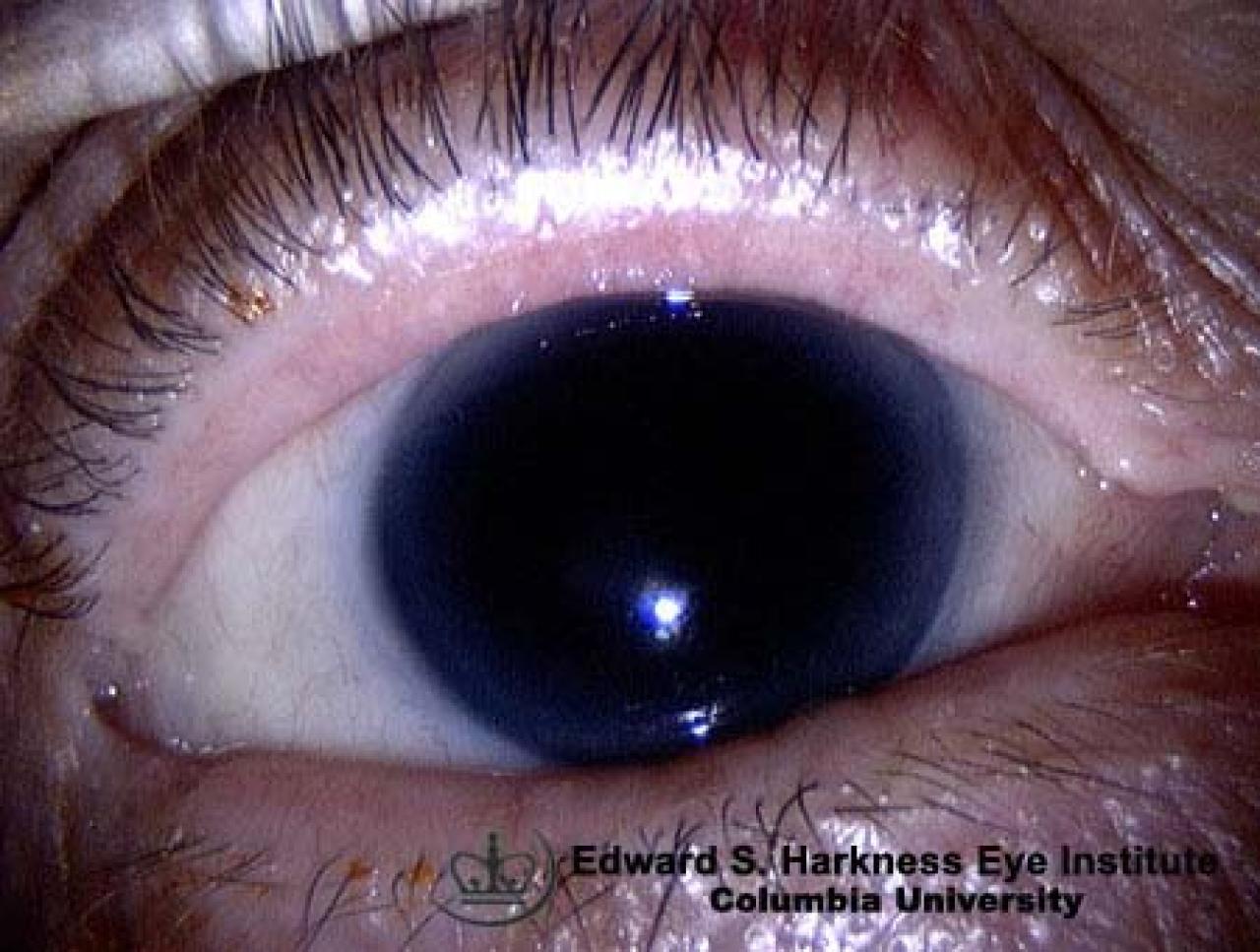 Aniridia | Vagelos College of Physicians and Surgeons