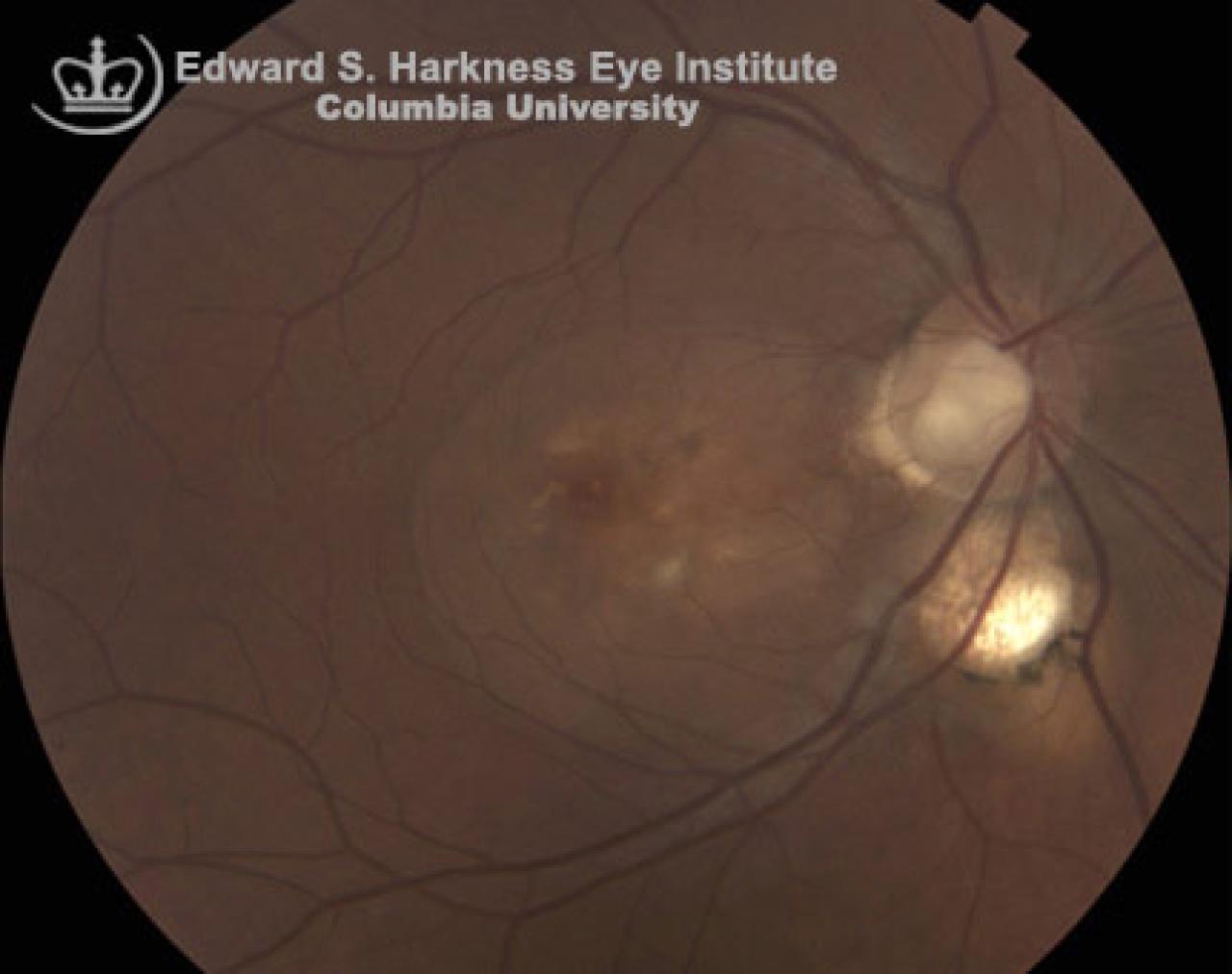 Optic Disc Pit | Vagelos College of Physicians and Surgeons