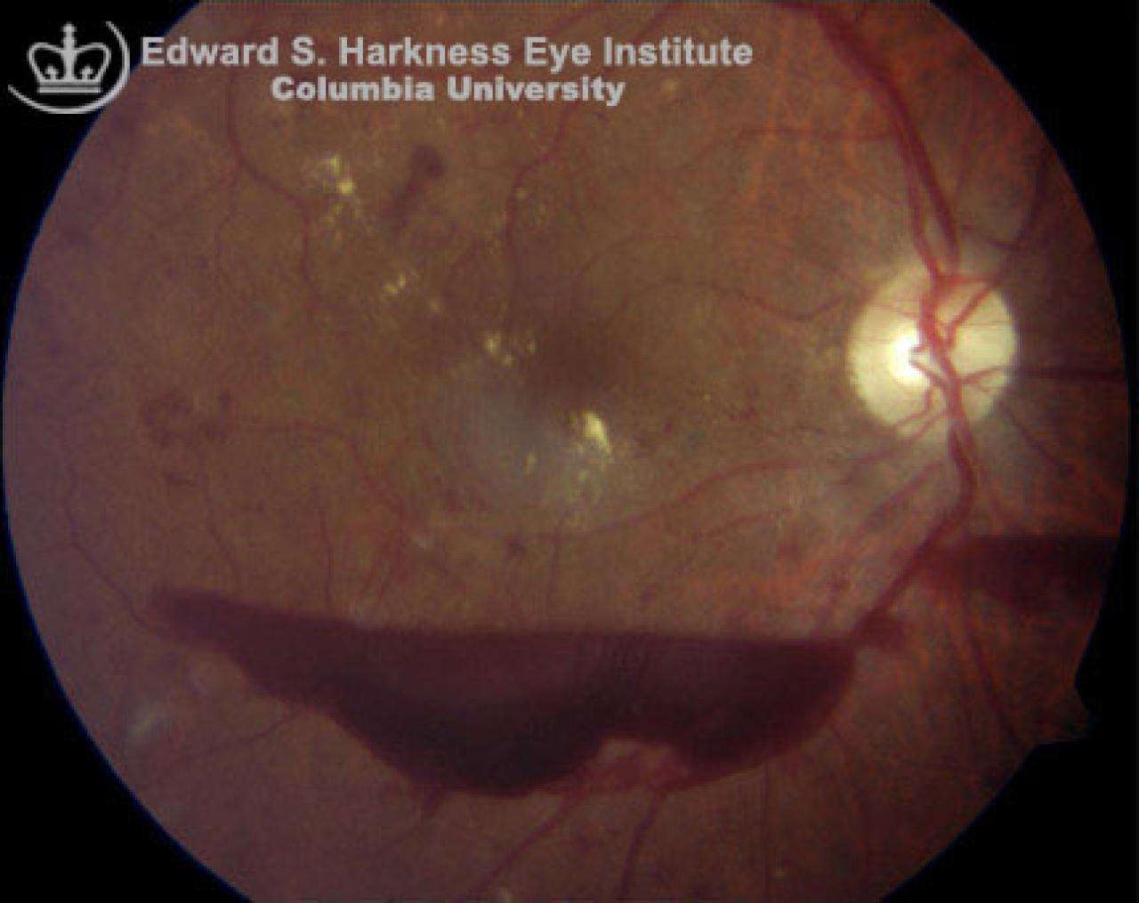 Preretinal Hemorrhage | Vagelos College of Physicians and Surgeons