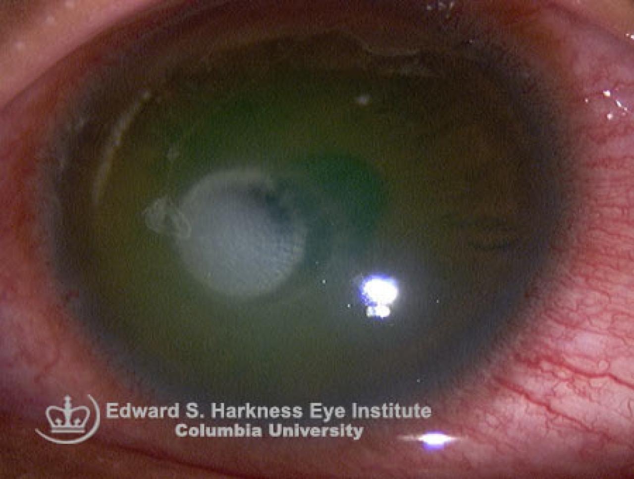 Acanthamoeba Keratitis | Vagelos College of Physicians and Surgeons