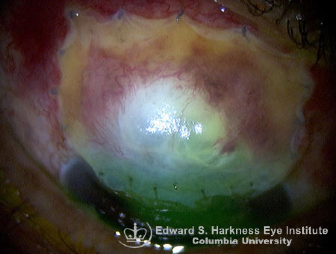 Amniotic Membrane Transplantation | Vagelos College of Physicians and ...