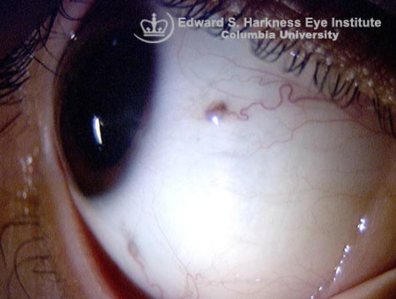 Axenfeld Nerve Loop | Vagelos College of Physicians and Surgeons