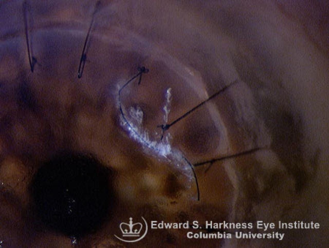 Broken Sutures | Vagelos College of Physicians and Surgeons