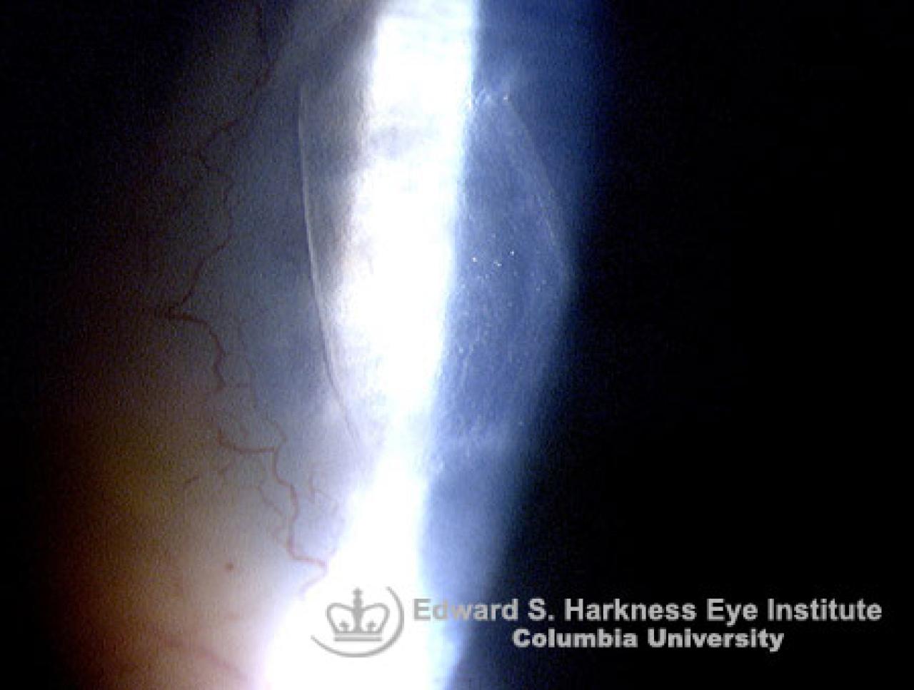 Clear Corneal Incision | Vagelos College of Physicians and Surgeons