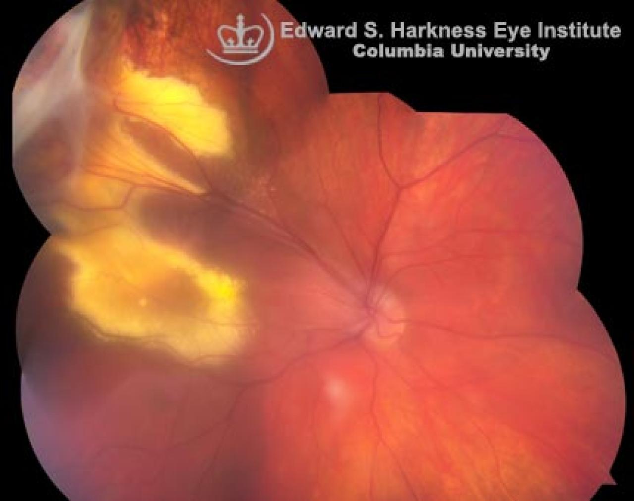Coats' Disease | Vagelos College of Physicians and Surgeons