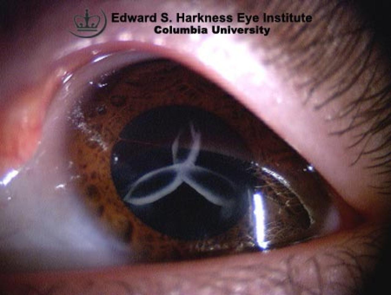 Congenital Sutural | Vagelos College of Physicians and Surgeons