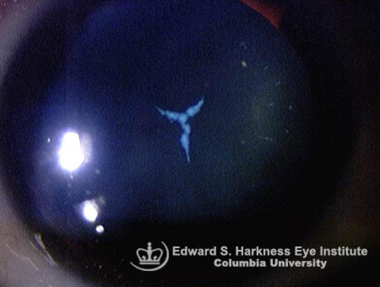 Congenital Sutural | Vagelos College of Physicians and Surgeons