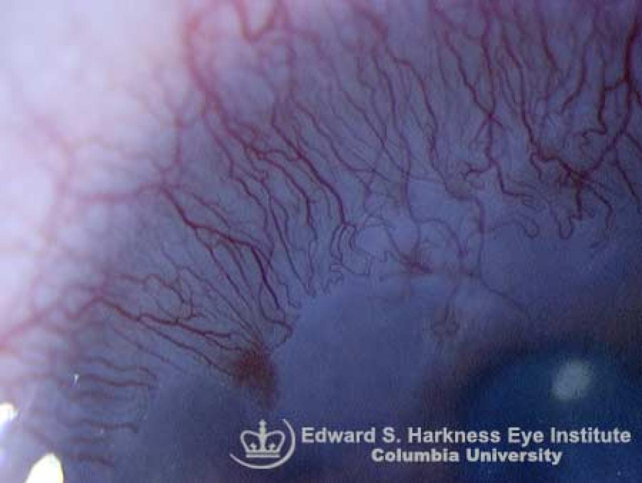 Corneal Intraepithelial Neoplasia | Vagelos College of Physicians and ...