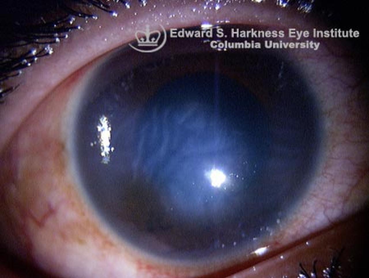 Corneal Blunt Trauma | Vagelos College of Physicians and Surgeons