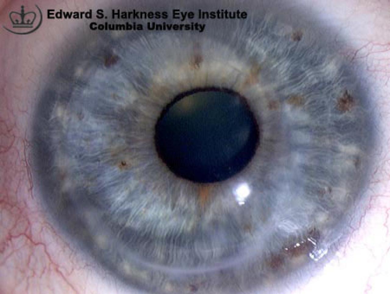 Eccentric Graft | Vagelos College of Physicians and Surgeons