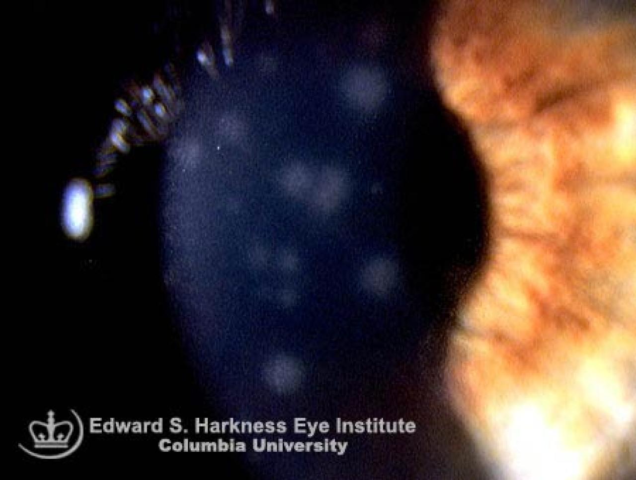 Epidemic Keratoconjunctivitis | Vagelos College of Physicians and Surgeons