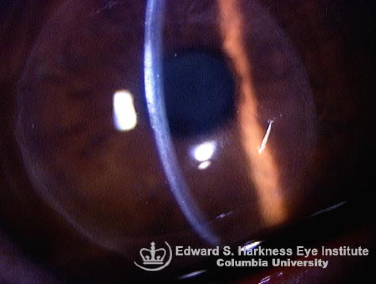 Epikeratophakia | Vagelos College of Physicians and Surgeons