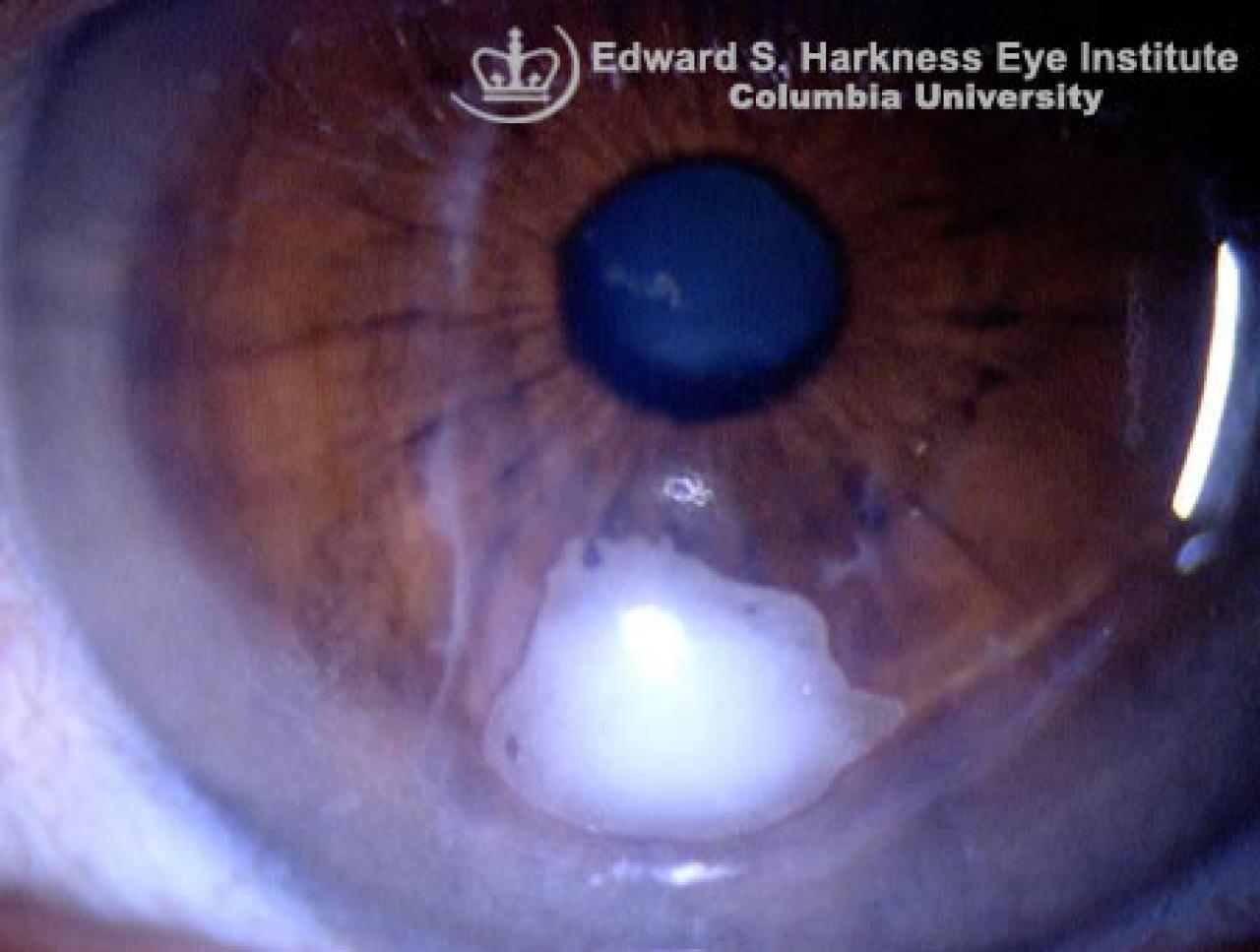 Epithelial Ingrowth | Vagelos College of Physicians and Surgeons