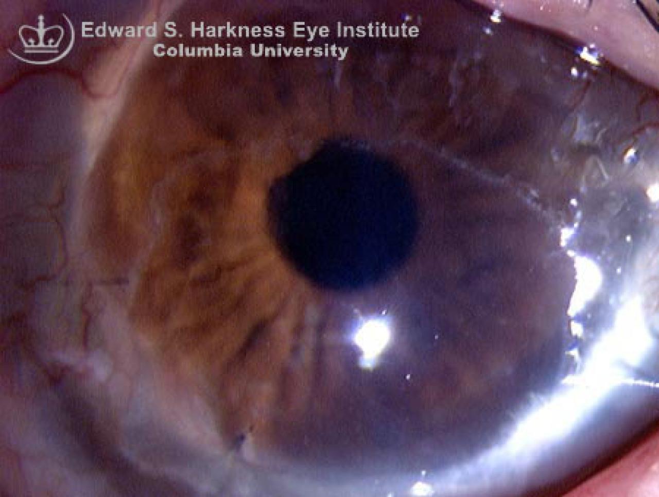 Epithelial Rejection Line | Vagelos College of Physicians and Surgeons