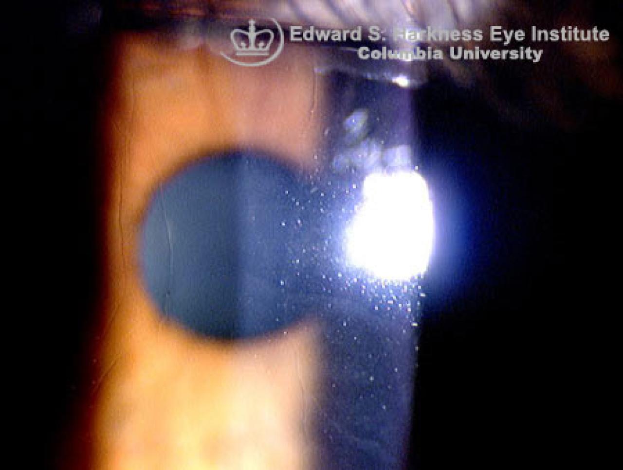 Flap Striae | Vagelos College of Physicians and Surgeons