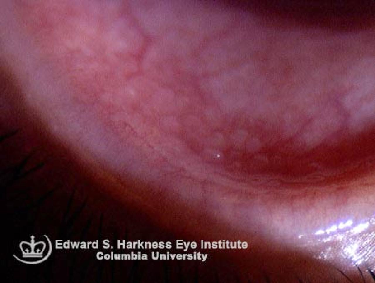 Follicular Conjunctivitis | Vagelos College of Physicians and Surgeons
