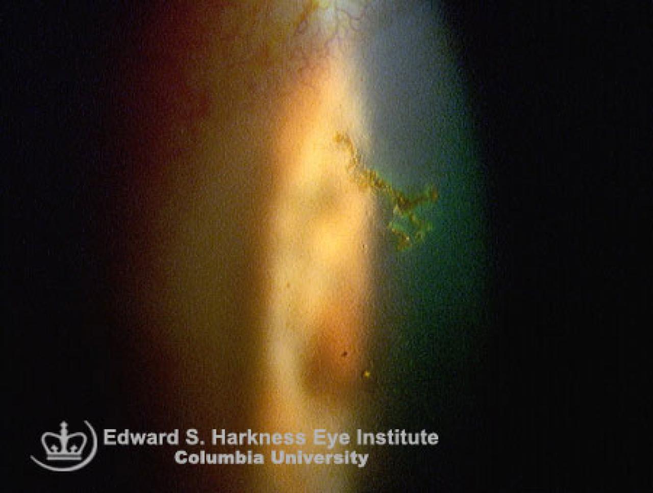 HSV Dendritic Epithelial Keratitis | Vagelos College of Physicians and ...