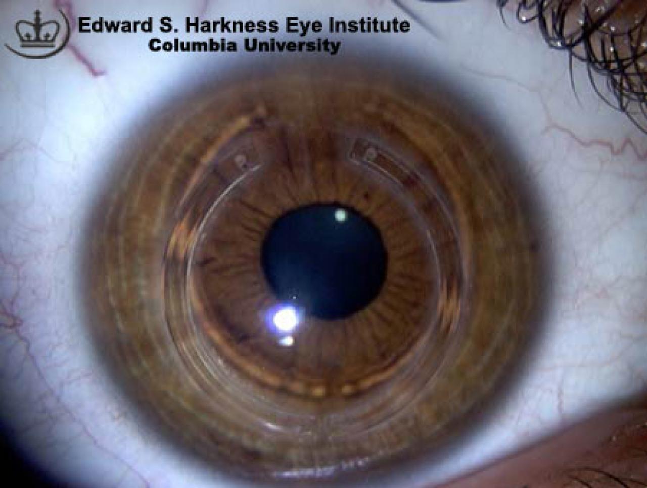 Intrastromal Corneal Ring | Vagelos College of Physicians and Surgeons