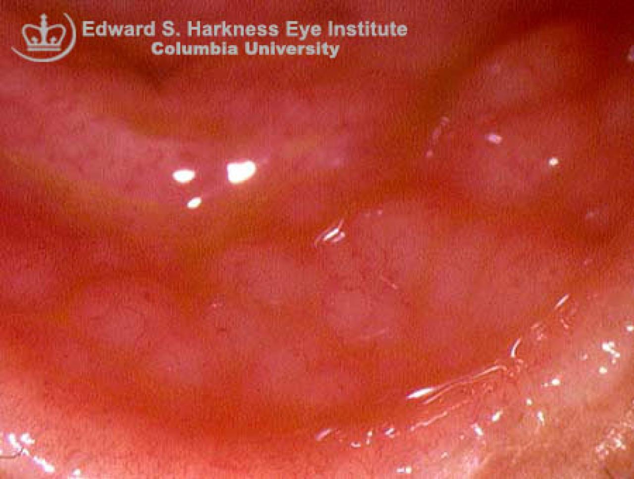 Lymphoid Tumor | Vagelos College of Physicians and Surgeons