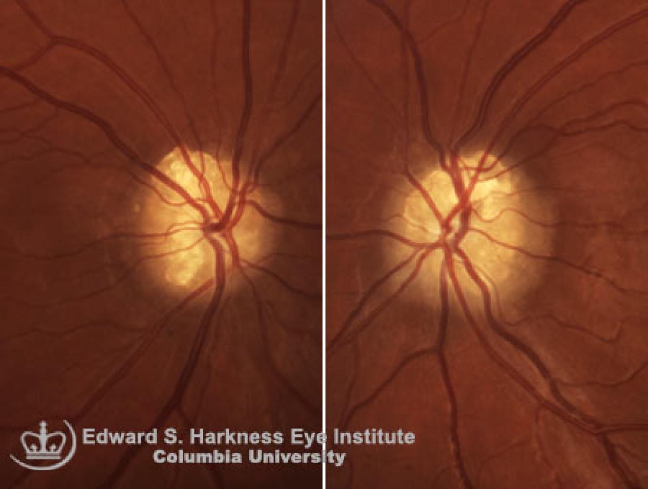 Optic Nerve Drusen | Vagelos College of Physicians and Surgeons