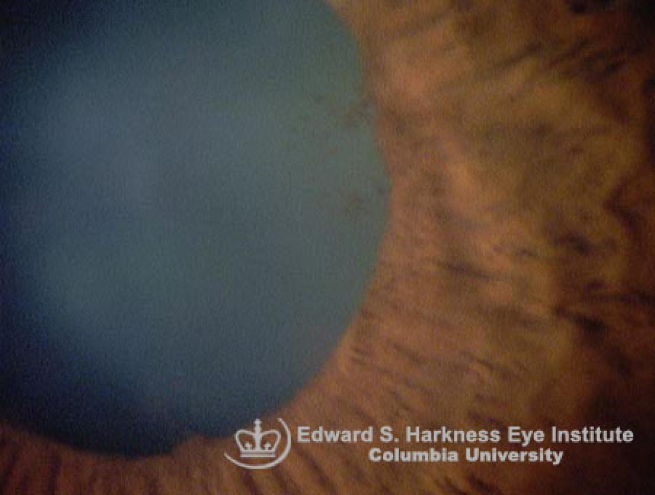 Posterior Synechiae | Vagelos College of Physicians and Surgeons