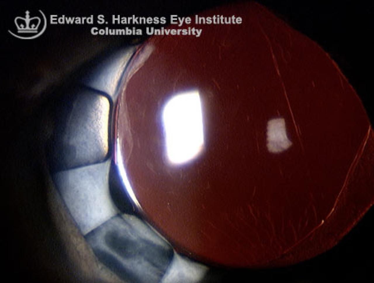 Prosthetic Iris Implant | Vagelos College of Physicians and Surgeons