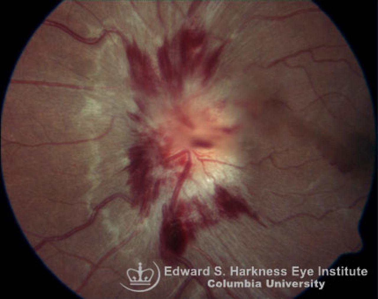 Pseudotumor Cerebri | Vagelos College of Physicians and Surgeons