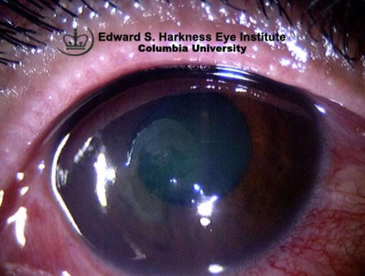 Recurrent Corneal Erosion | Vagelos College of Physicians and Surgeons