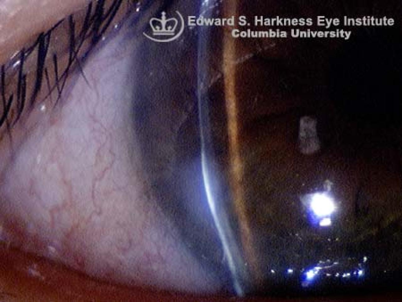 Salzmann's Nodules | Vagelos College of Physicians and Surgeons