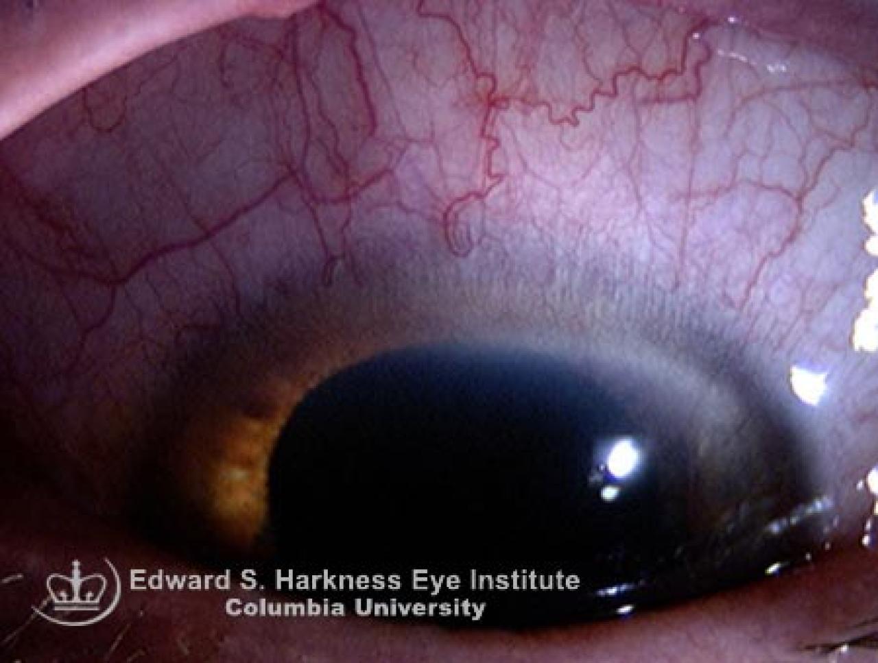 Superior Limbic Keratoconjunctivitis | Vagelos College of Physicians ...