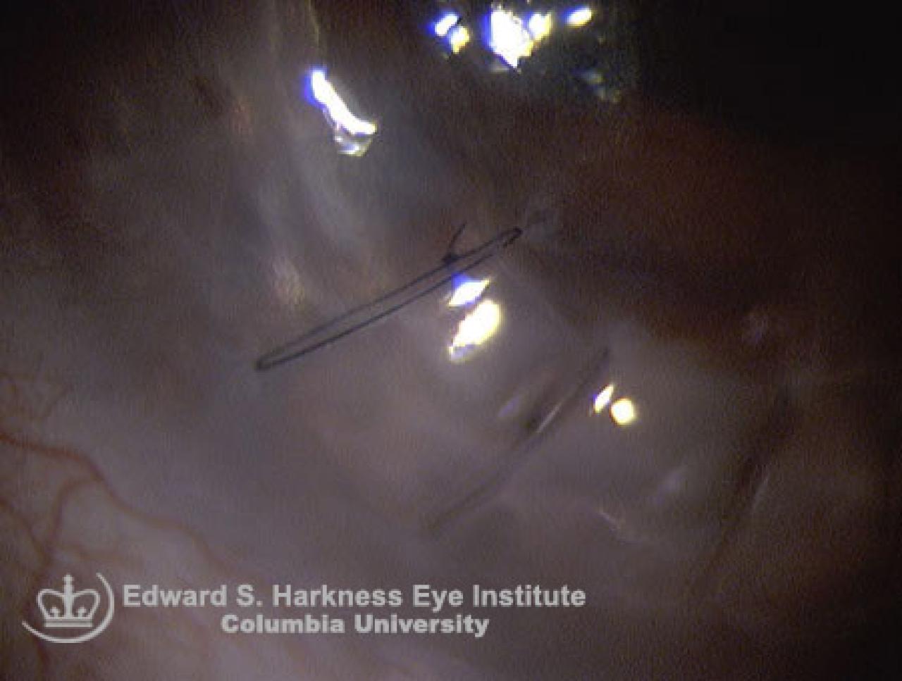 Tight Sutures | Vagelos College of Physicians and Surgeons