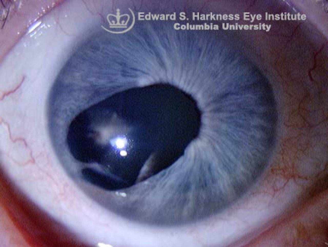 Traumatic Iris Coloboma | Vagelos College of Physicians and Surgeons