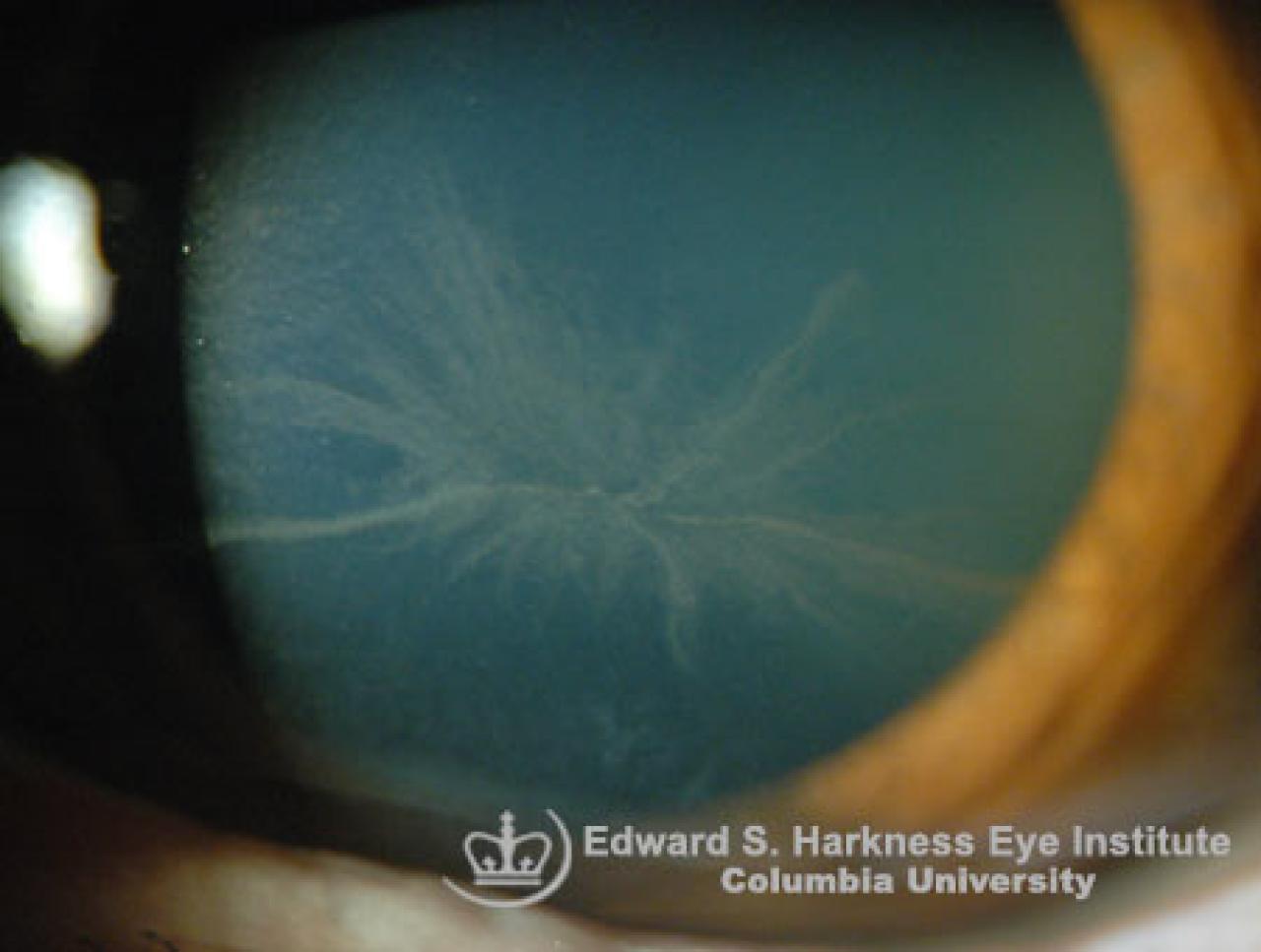 Vortex Keratopathy | Vagelos College of Physicians and Surgeons