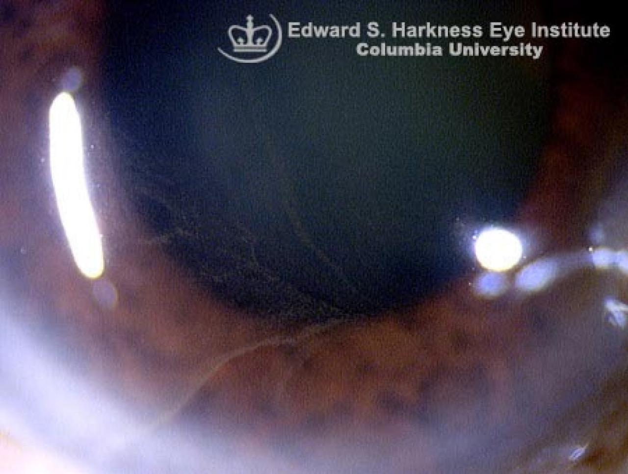 Vortex Keratopathy | Vagelos College of Physicians and Surgeons