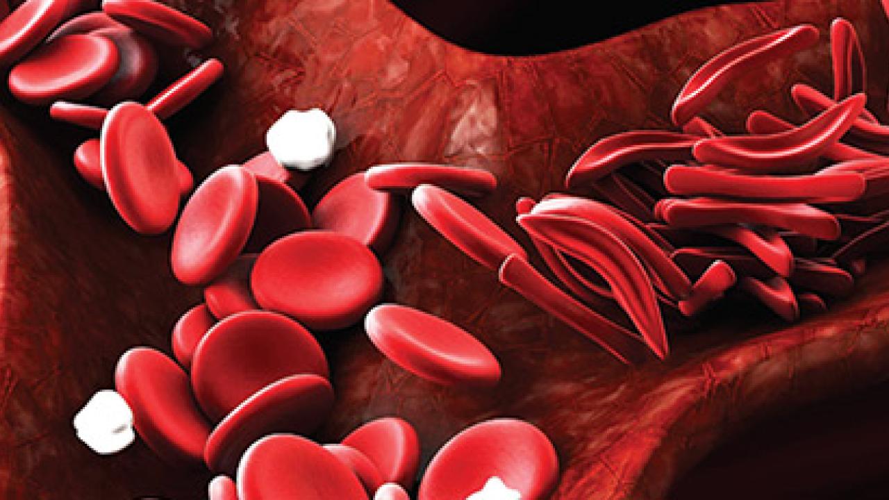 Is a Genetic Cure for Sickle Cell Disease on the Horizon? | Vagelos ...