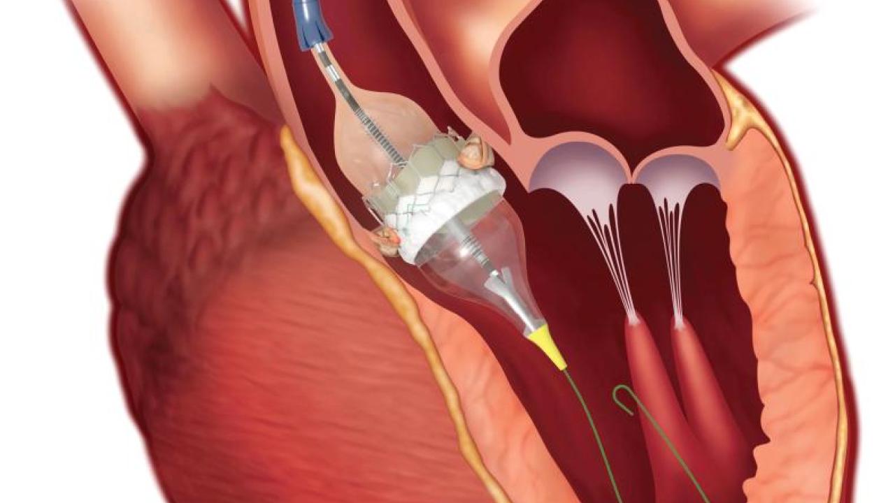 Expanding the Use of TAVR for Aortic Stenosis | Vagelos College of Physicians and Surgeons