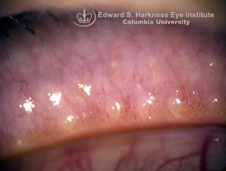 Chronic Meibomitis | Vagelos College of Physicians and Surgeons