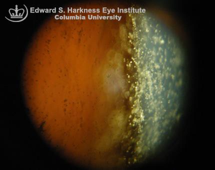 Asteroid Hyalosis | Vagelos College of Physicians and Surgeons