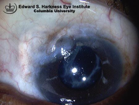 Filtering Bleb Failure | Vagelos College of Physicians and Surgeons