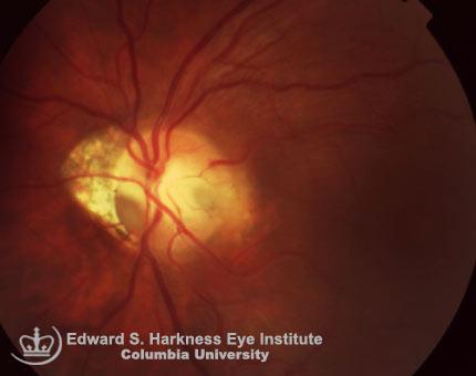 Optic Disc Pit | Vagelos College of Physicians and Surgeons